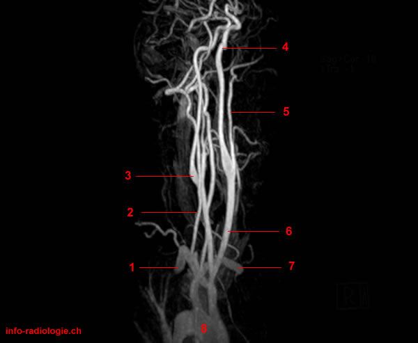 MRA of the Carotid and Vertebral Arteries - W-Radiology