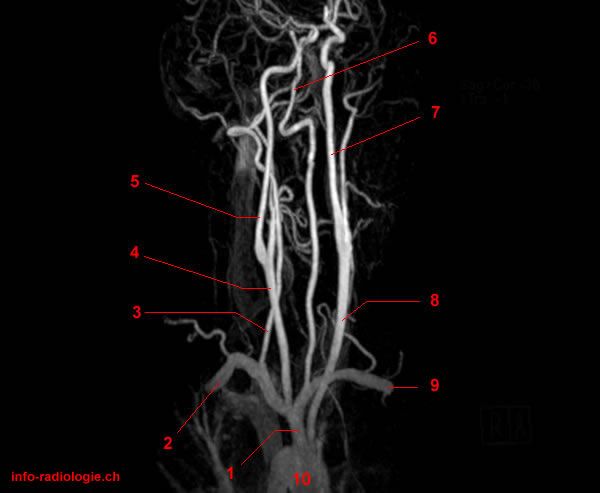 MRA of the Carotid and Vertebral Arteries - W-Radiology