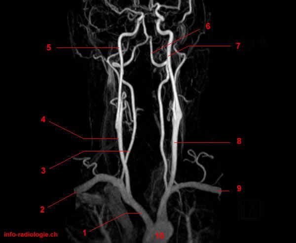 MRA of the Carotid and Vertebral Arteries - W-Radiology