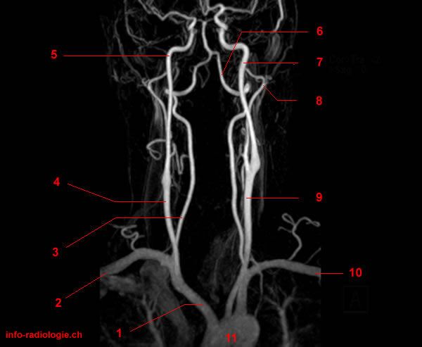 MRA of the Carotid and Vertebral Arteries - W-Radiology