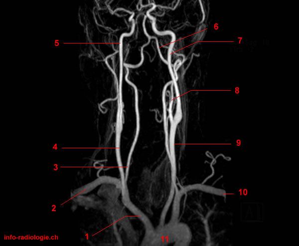 MRA of the Carotid and Vertebral Arteries - W-Radiology