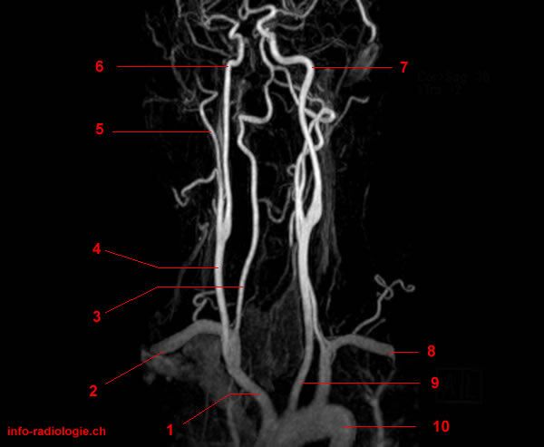 MRA of the Carotid and Vertebral Arteries - W-Radiology