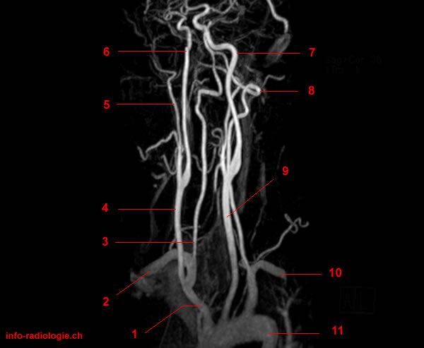 MRA of the Carotid and Vertebral Arteries - W-Radiology