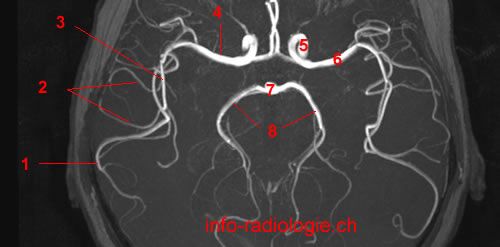 Middle Cerebral Artery - W-Radiology