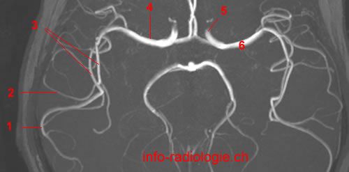 Middle Cerebral Artery - W-Radiology