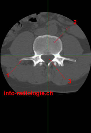 Lumbar Spine Computed Tomography - W-Radiology