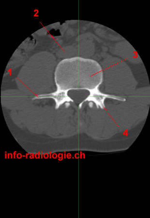 Lumbar Spine Computed Tomography - W-Radiology