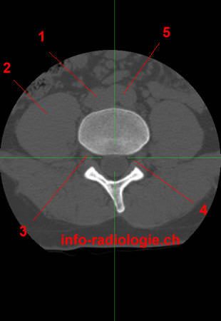 Lumbar Spine Computed Tomography - W-Radiology