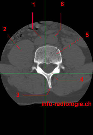Lumbar Spine Computed Tomography - W-Radiology