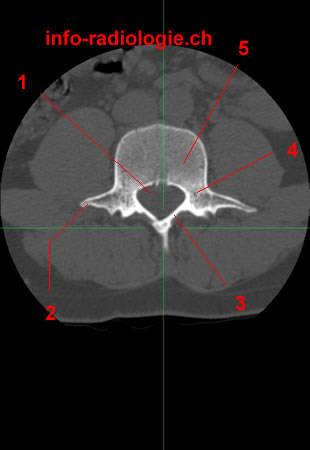 Lumbar Spine Computed Tomography - W-Radiology