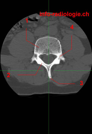 Lumbar Spine Computed Tomography - W-Radiology