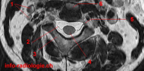 Cervical Spine MRI Anatomy - W-Radiology