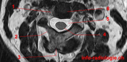 Cervical Spine MRI Anatomy - W-Radiology