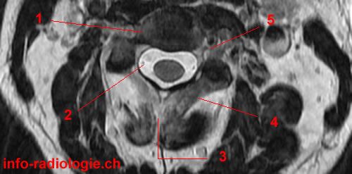 Cervical Spine MRI Anatomy - W-Radiology