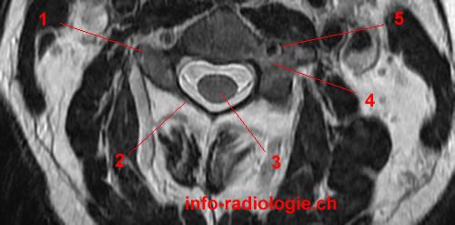 Cervical Spine MRI Anatomy - W-Radiology