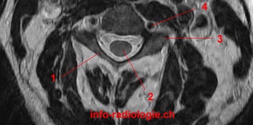 Cervical Spine MRI Anatomy - W-Radiology