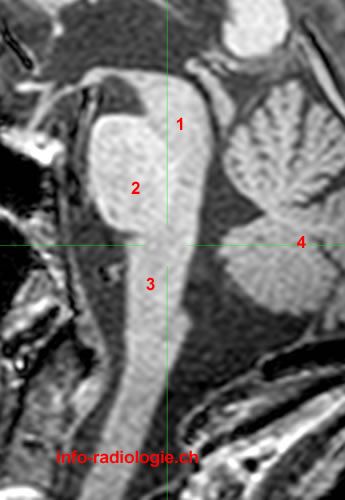 Medulla (Anatomy with MRI) - W-Radiology