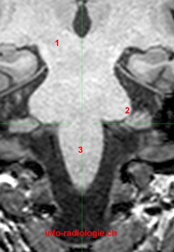 Medulla (Anatomy with MRI) - W-Radiology