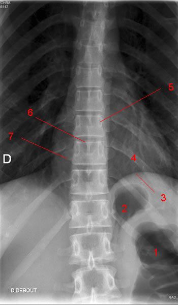 Thoracic Spine X-ray - W-Radiology
