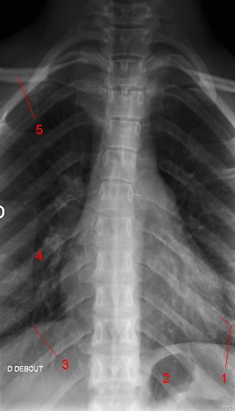 Thoracic Spine X-ray - W-Radiology
