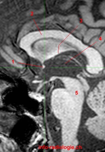 Anterior Commissure - Posterior Commissure - W-Radiology