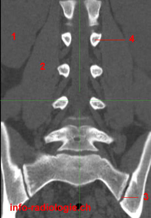 Lumbar Spine Computed Tomography - W-Radiology