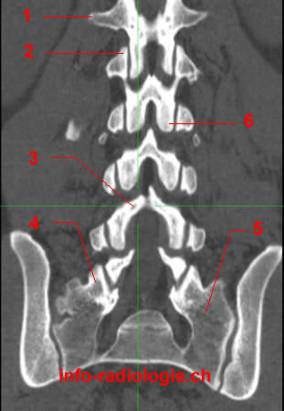 Lumbar Spine Computed Tomography - W-Radiology