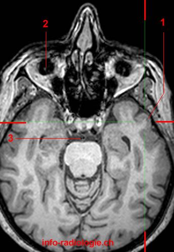 Temporal Lobe - W-Radiology