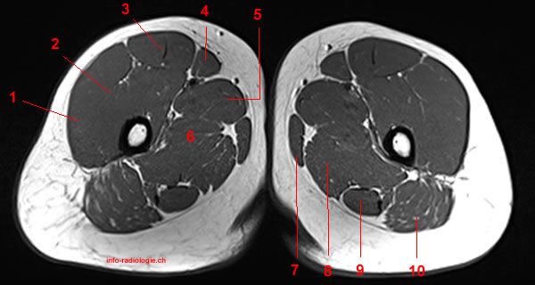Thigh Anatomy Mri PLAN THIGH Stir Axial Mrimaster