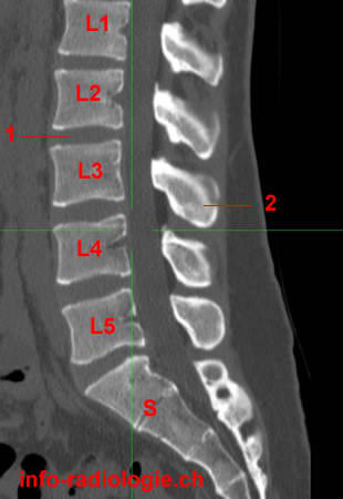 Lumbar Spine Computed Tomography - W-Radiology