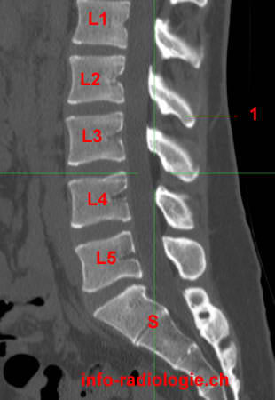 Lumbar Spine Computed Tomography - W-Radiology