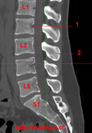 Lumbar Spine Computed Tomography - W-Radiology