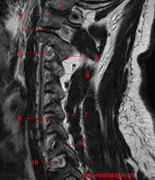 Cervical Spine MRI Anatomy - W-Radiology