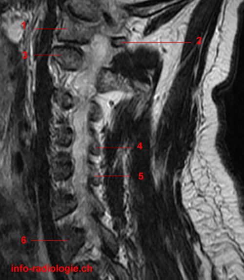 Cervical Spine MRI Anatomy - W-Radiology