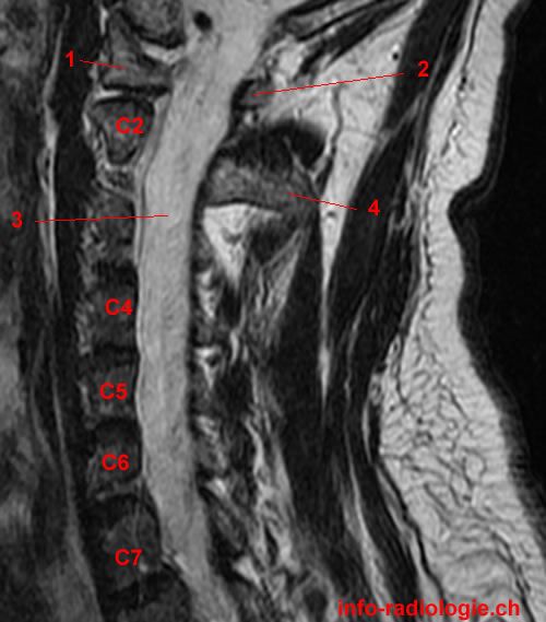 Cervical Spine MRI Anatomy - W-Radiology