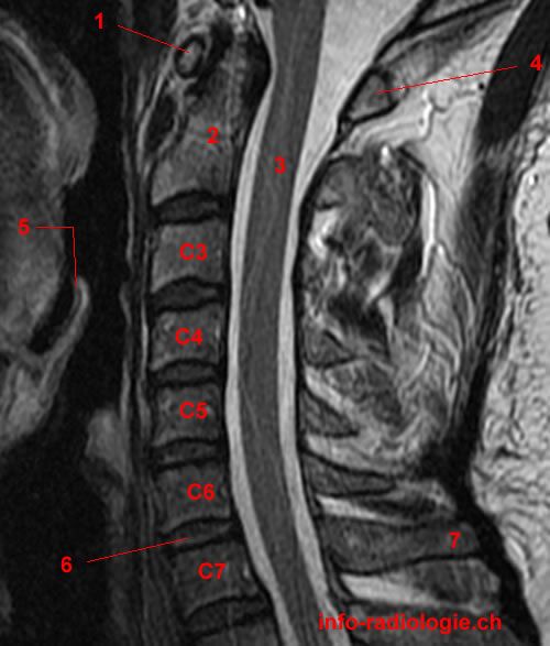 Cervical Spine MRI Anatomy - W-Radiology