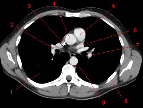 Thorax Ct Scan Chest CT Scan Melbourne Radiology