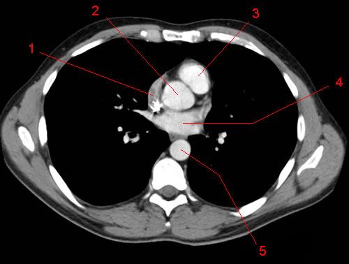 Ct Anatomy Chest