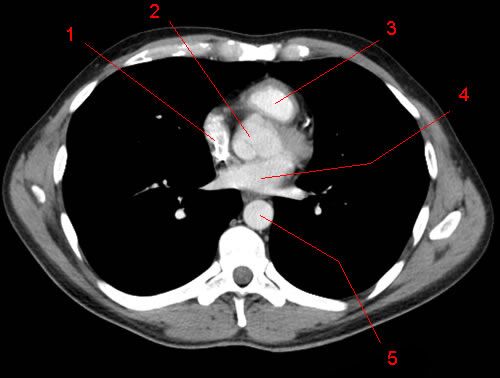 Atlas of CT Anatomy of the Chest - W-Radiology
