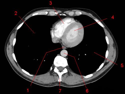 Atlas of CT Anatomy of the Chest - W-Radiology
