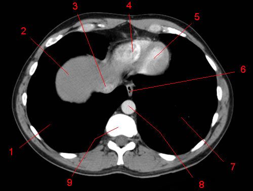 Atlas of CT Anatomy of the Chest - W-Radiology