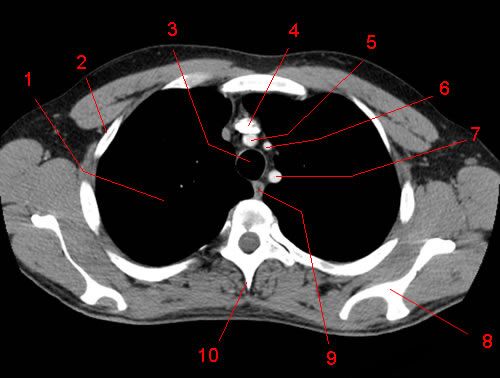 Atlas of CT Anatomy of the Chest - W-Radiology
