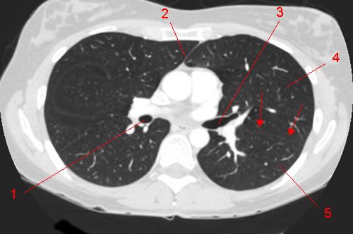 Chest Computed Tomography - W-Radiology