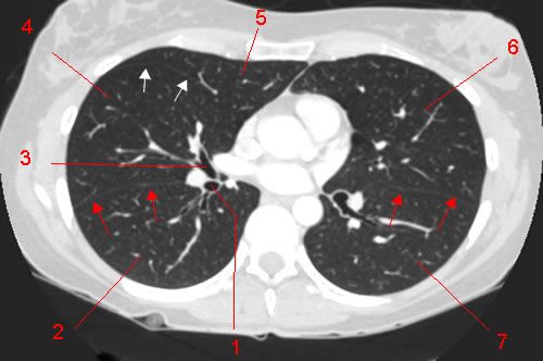 Chest Computed Tomography - W-Radiology
