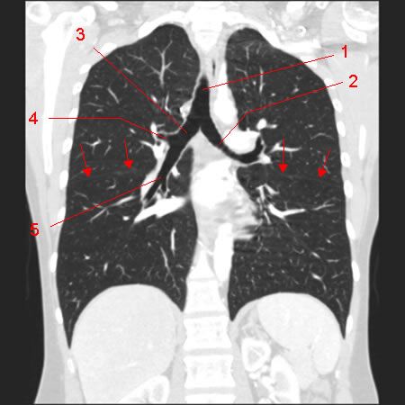 Chest Computed Tomography - W-Radiology