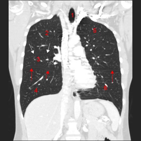 Chest Computed Tomography - W-Radiology