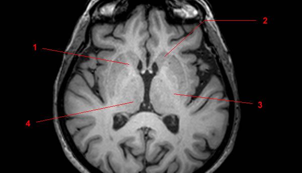 MRI of the White and Gray Matter in the Brain - W-Radiology