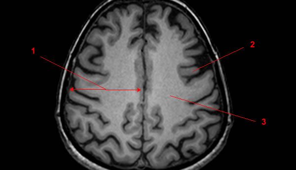 Grey Matter Mri Measurement And Clinical Effect Of Grey Matter