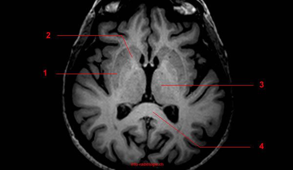 Axial Brain Anatomy
