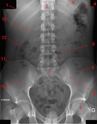 Abdominal X-ray - W-Radiology